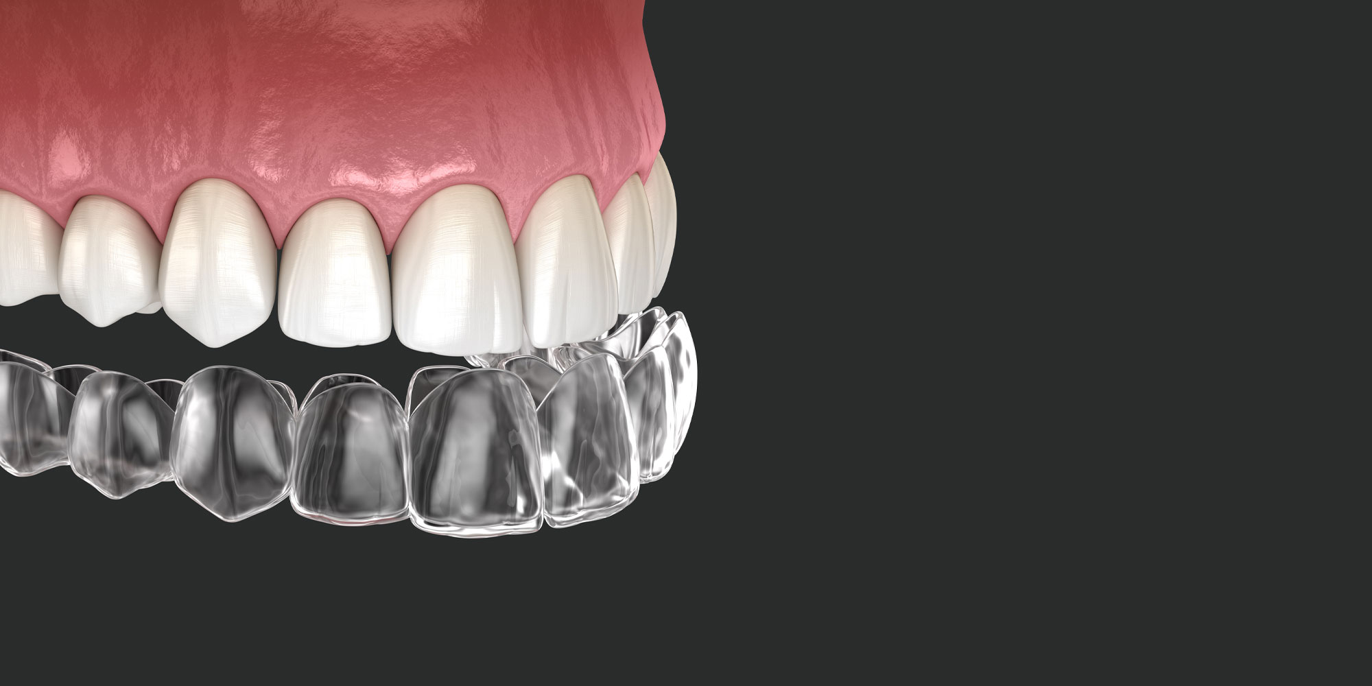 Invisalign® - Avason Family Dentistry